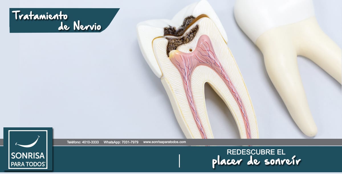 Endodoncia o tratamiento de nervio Costa Rica -Sonrisa Para Todos