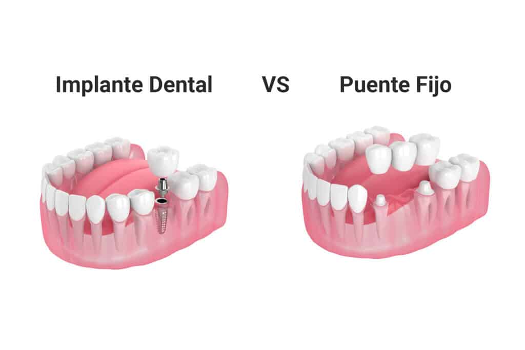 Implantes Dentales VS Puente Fijo - Sonrisa Para Todos