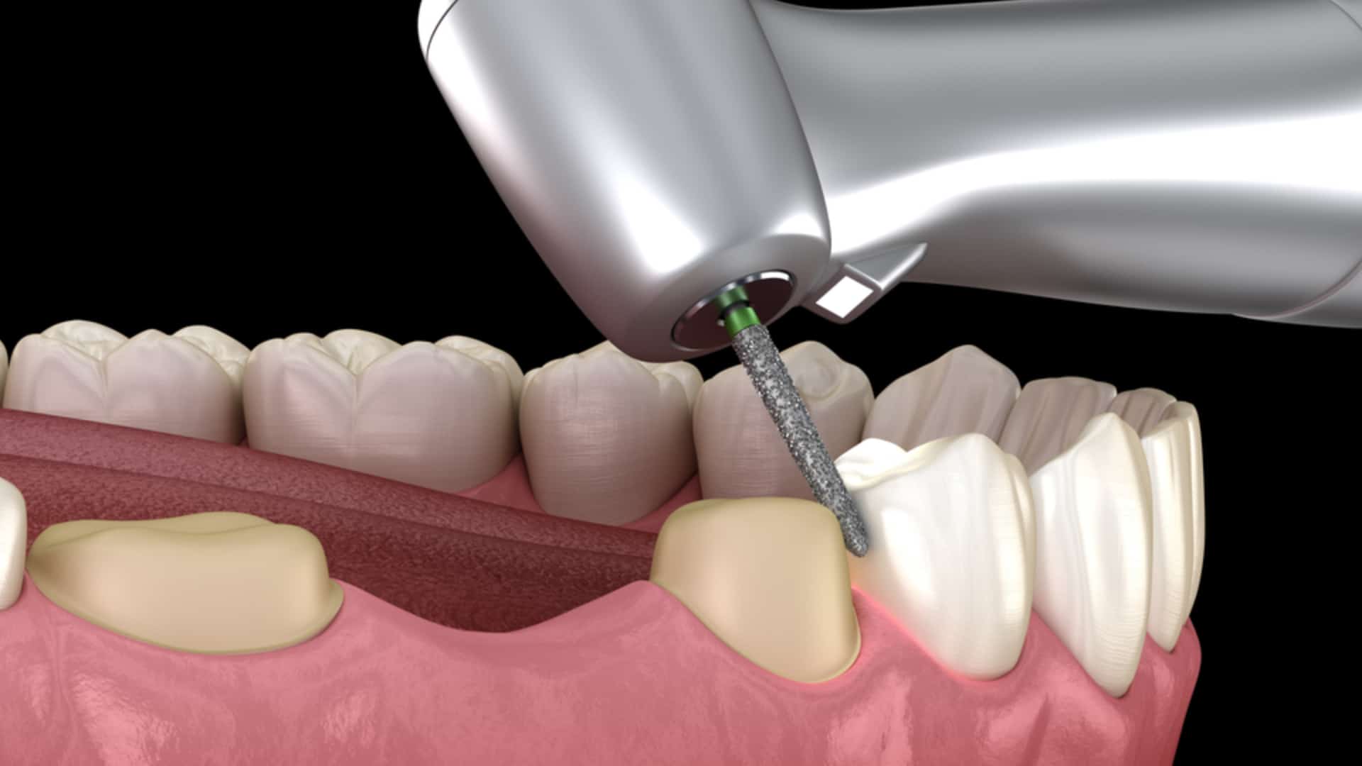 50 preguntas frecuentes acerca de coronas dentales y puentes fijos