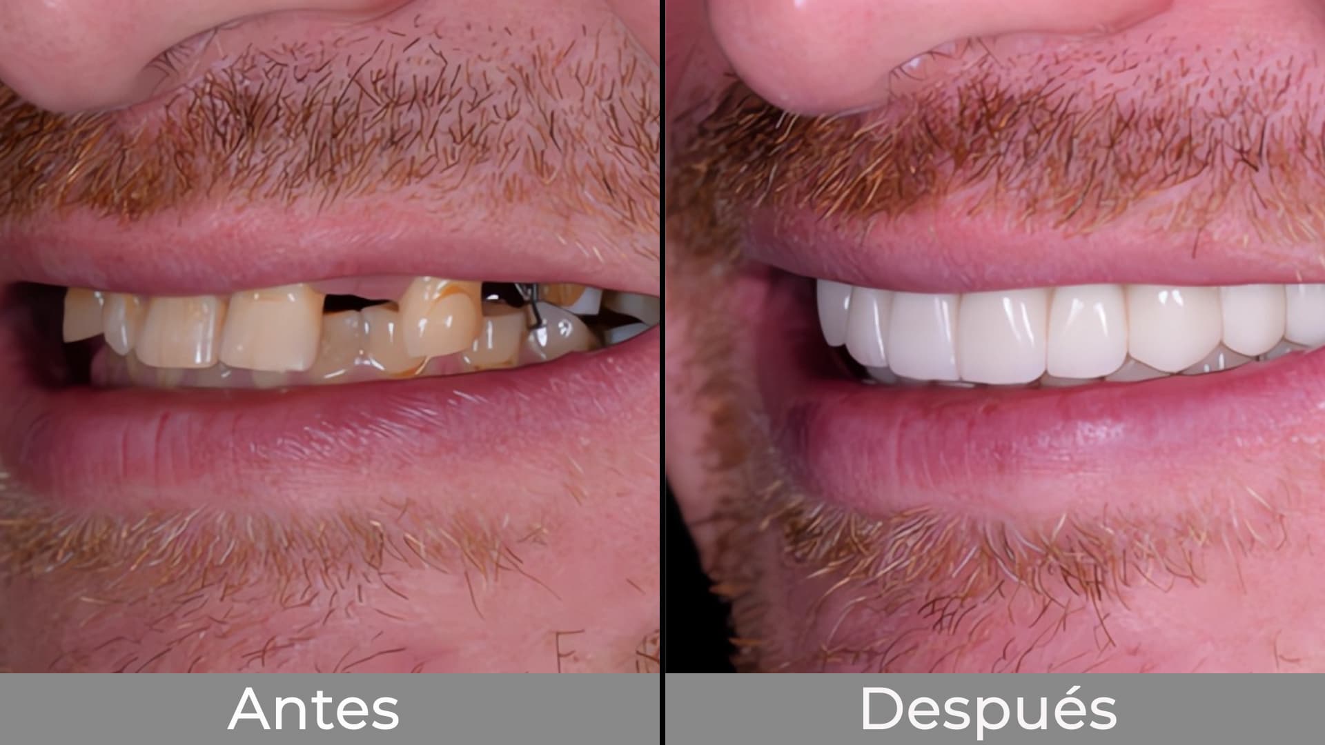 50 preguntas frecuentes acerca de coronas dentales y puentes fijos