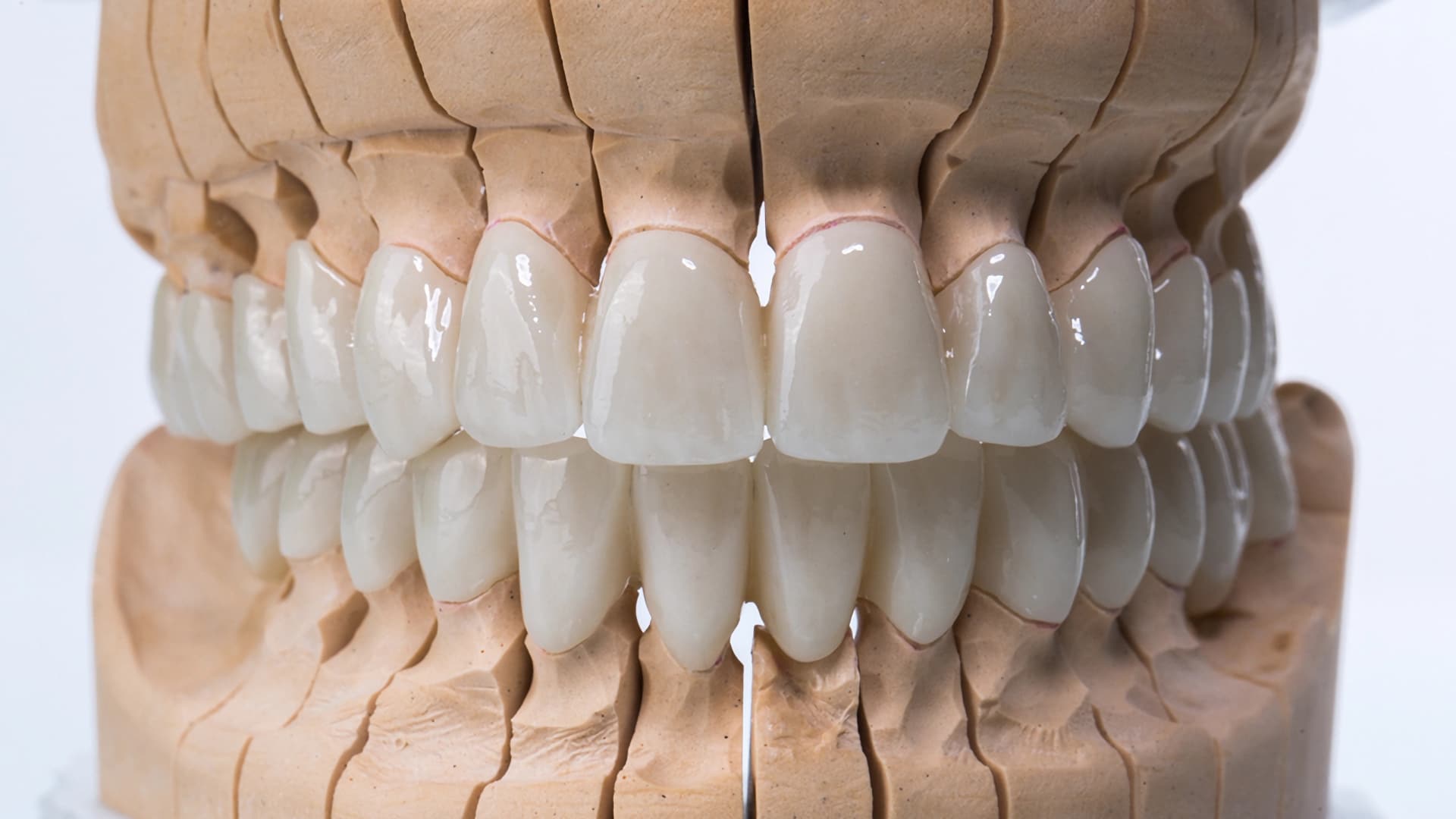 50 preguntas frecuentes acerca de coronas dentales y puentes fijos
