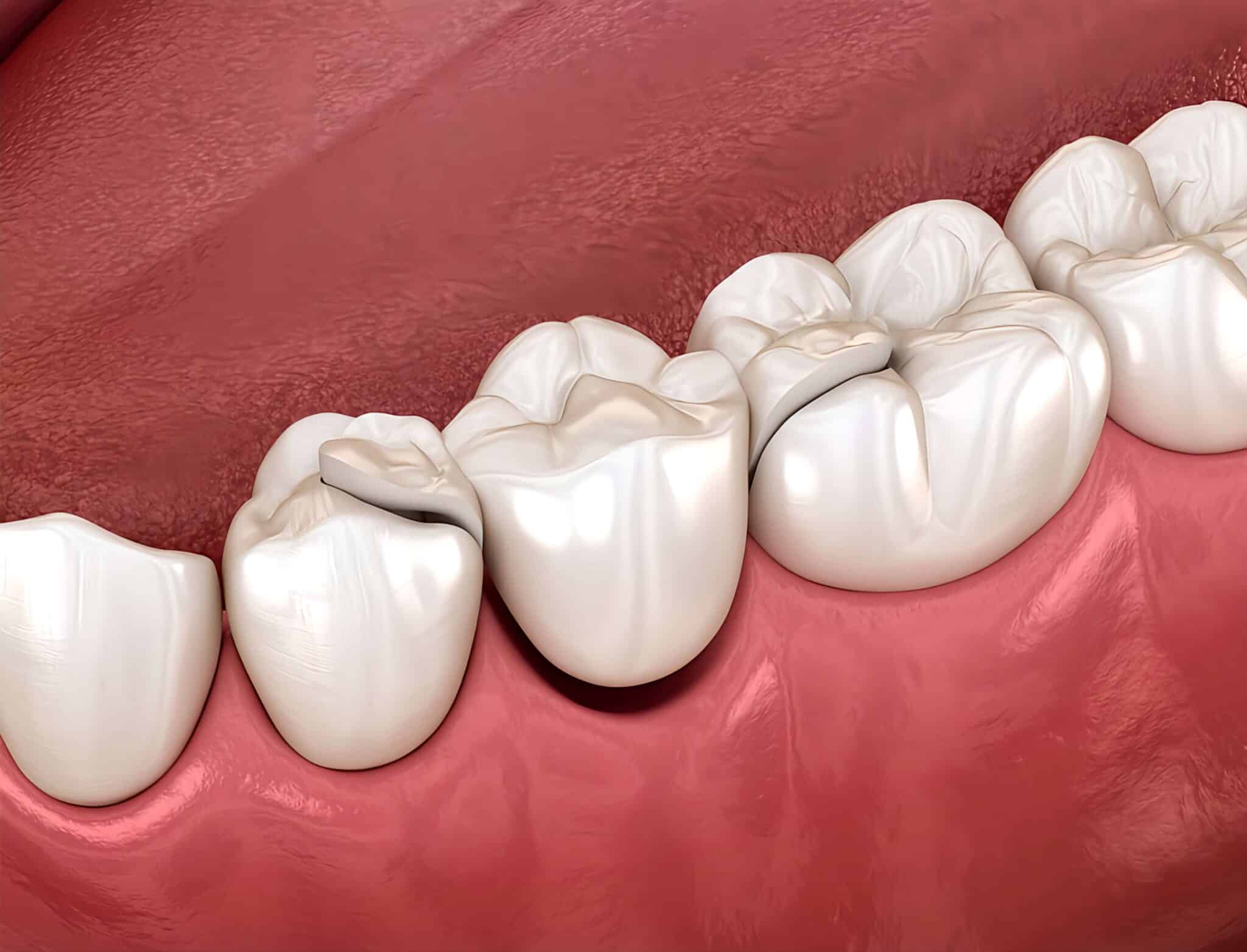 Puentes Dentales Fijos - Sonrisa Para Todos