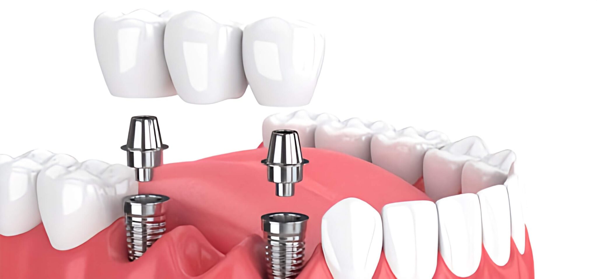 Puentes Dentales Fijos - Sonrisa Para Todos