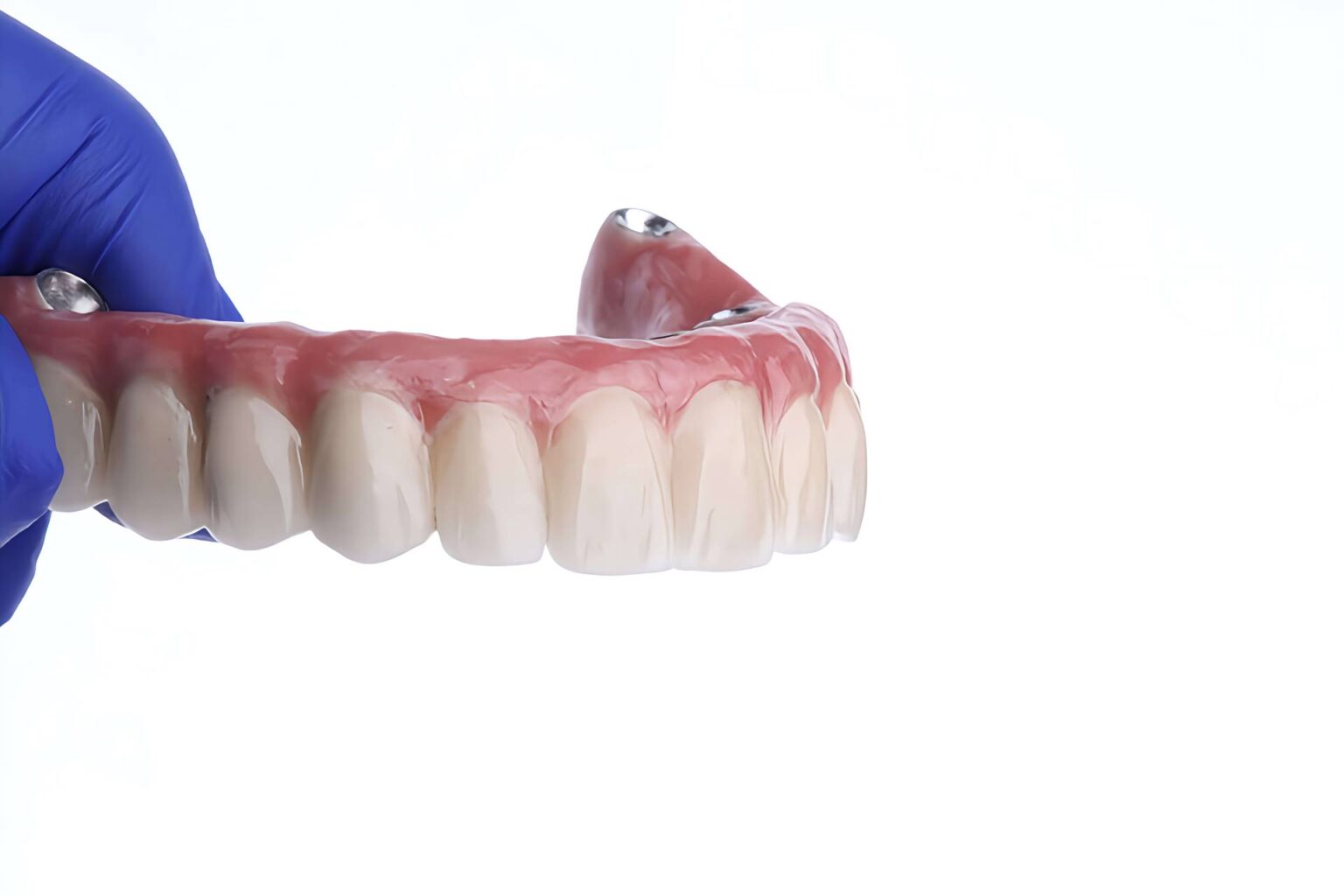 What is a hybrid prosthesis on dental implants? - Smile For All
