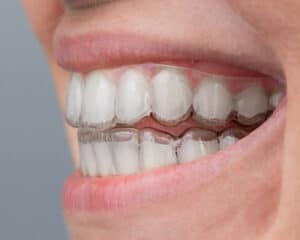 Ortodoncia Invisalign en Costa Rica - Sonrisa Para Todos